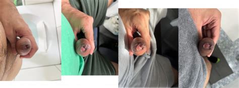 Phimosistight Foreskin At 41 Lpsg