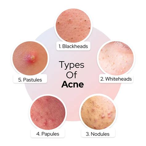 A Dermatologists Perspective To Understanding Acne Types