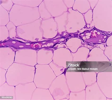 Lipoma On Cubital Fossa Benign Growth Of Fatty Tissue Benign Neoplasm