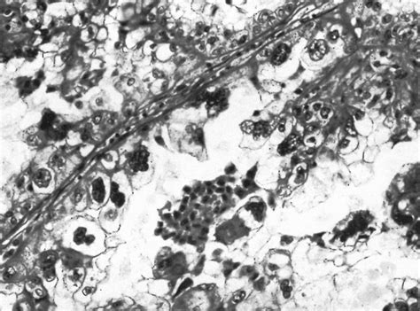 Pathology Outlines Clear Cell Carcinoma