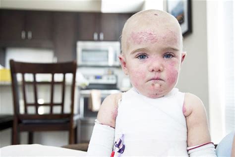Primer caso de éxito en el tratamiento de la epidermolisis bullosa o piel de mariposa Código F