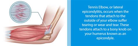Lateral Epicondyle Injection