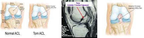 Acl Rupture Home Acl Rupture Home