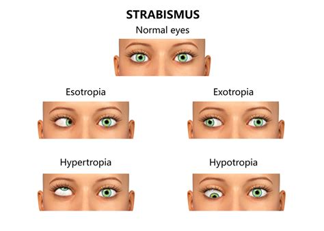Strabismus Its Different Types And Risk Factors Doral Healthcare And Wellness