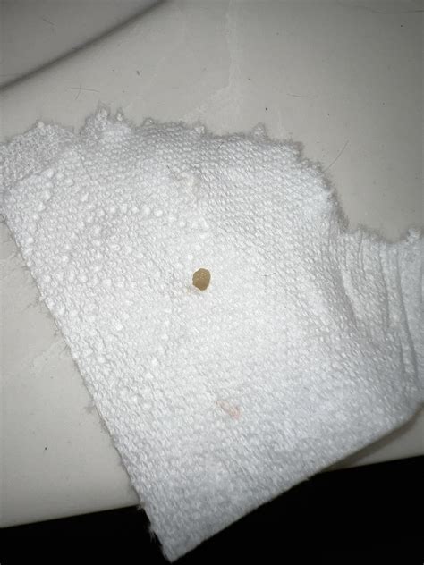 How Do My Tonsils Look Rtonsilstones