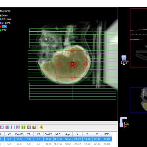 Beam Field Edit 223 Simulation In S3 Segment S3 Tallies The Dose