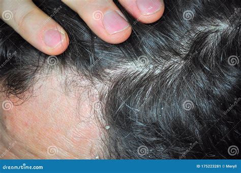 Itching Scalp Hair Skin Issue Stock Image Image Of Care Dermatological