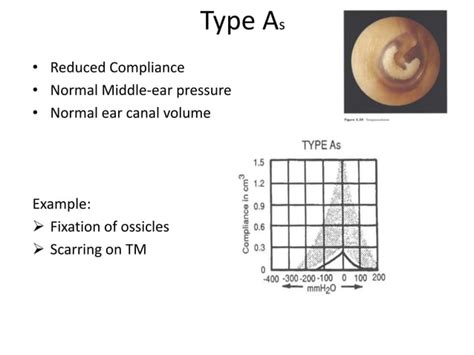 Tympanometry Pptx Ear Nose And Throat Conditions Diseases And Conditions