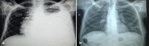 A Cxr At Presentation B Follow Up Cxr After 4 Days Case 2 Figure