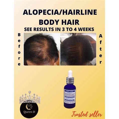 Thailand Minoxidil 15 Alcohol Base Hair Tonic 1bot Lazada Ph