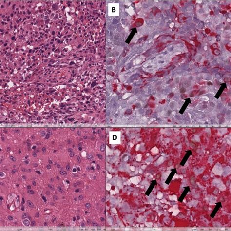 Within The Tumor Core Pstat3 Expression Was Restricted To Few