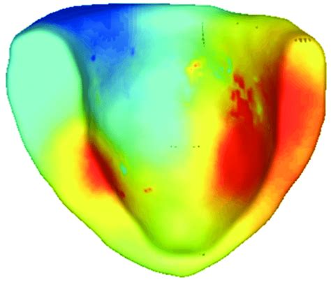 simulation of electrical propagation in a human left ventricle a and