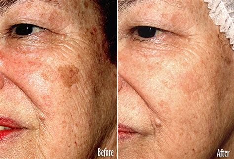 Age Apots Castleknock Cosmetic Clinic Dublin Castleknock Cosmetic Clinic