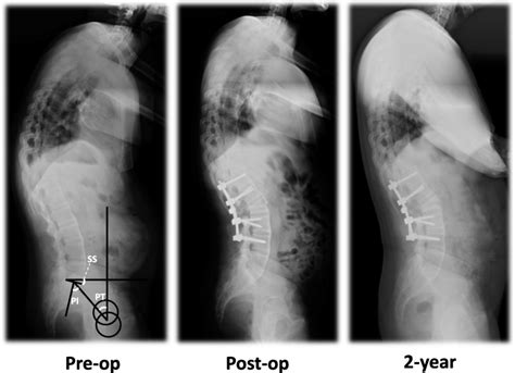 Preoperative Immediate Postoperative And 2 Year Postoperative Standing