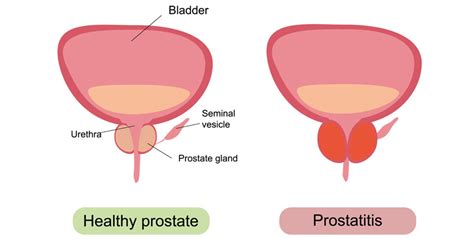 Whats A Normal Prostate Size And How To Tell Its Enlarged