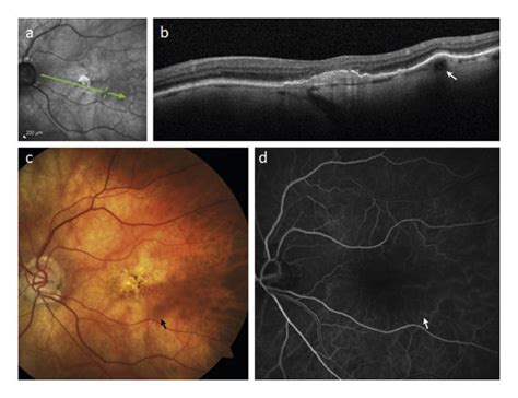Imaging Characteristics Of A Focal Choroidal Elevation In A Patient Download Scientific Diagram