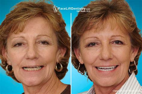 What Is Face Lift Dentistry
