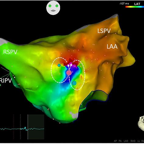 Small Loop Reentrant Atrial Tachycardia With A Figure Of Eight Pattern Download Scientific