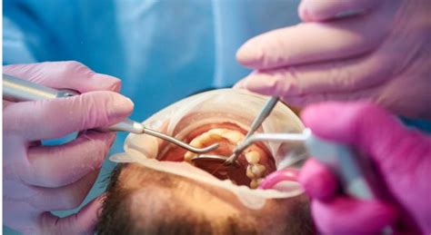 The Critical Differences Between Plaque Tartar And Cavities