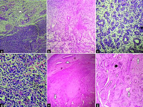 Uterine Angioleiomyoma With Perivascular Swirling Of Smooth Muscles And