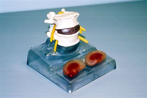 A Herniated Disc Pathophysiology Of A Herniated Disc