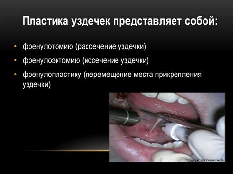 Виды уздечек губ и языка Показания к пластике уздечек губ и языка презентация онлайн
