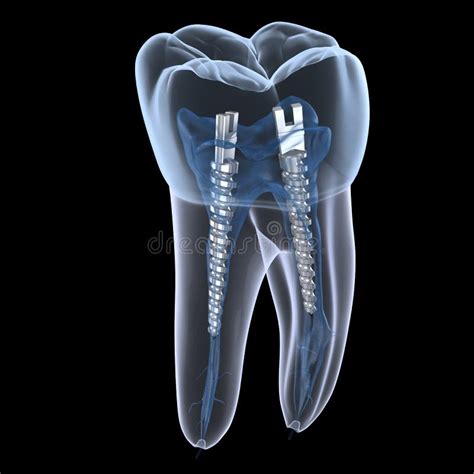 Dental Steel Post Inside Molar Teeth Xray View Dental Endodontic