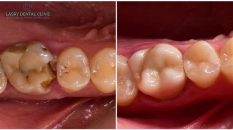 Sepsis Rotting Teeth Is This An Infection Or Polyp Seeing Dentist On