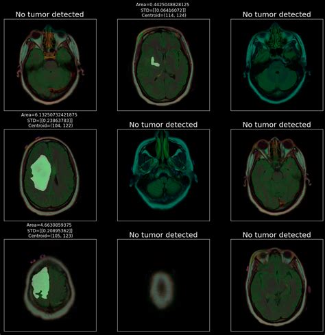 Brain Mri Segmentation With 095 Dice Score Analytics Vidhya