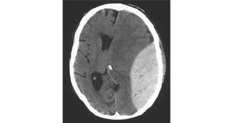 NEURO IMAGING MRI CT Flashcards Quizlet