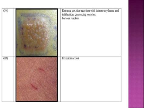 Patch Test In Dermatology