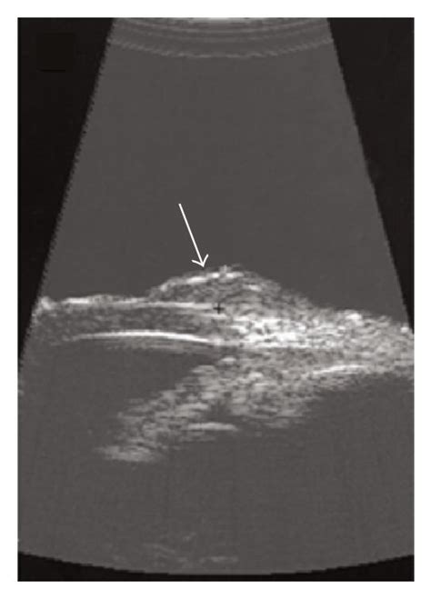 20 Mhz Transverse A And Longitudinal B Ultrasound Biomicroscopy