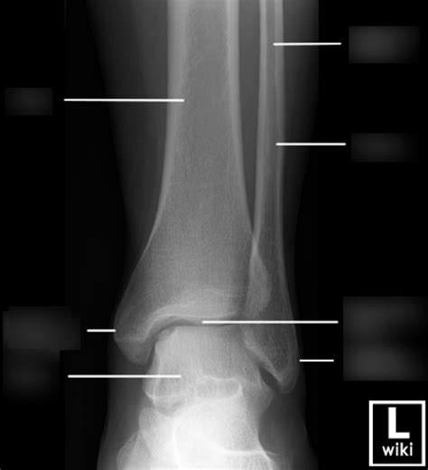 RADR AP Ankle Radiograph Diagram Quizlet