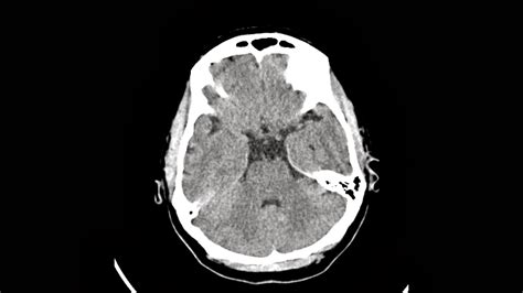 Ultimate Radiology Fetal Pca