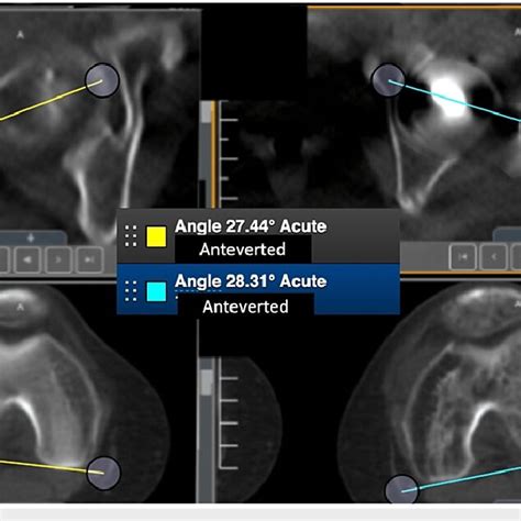 Measurement Of Femoral Version Based On Ct Scanogram Axial Views A