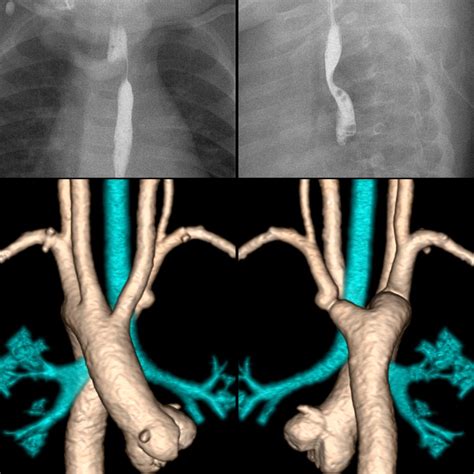 Pediatric Right Aortic Arch With Aberrant Left Subclavian Artery
