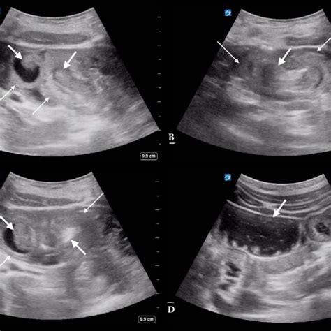 A C Showing Intussusception Site With Outer Intussuscipiens Thin