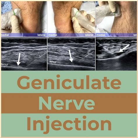Genicular Nerve Injections Sports Medicine Review