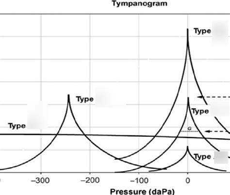 Diagram Of Tympanogram Classifications Quizlet
