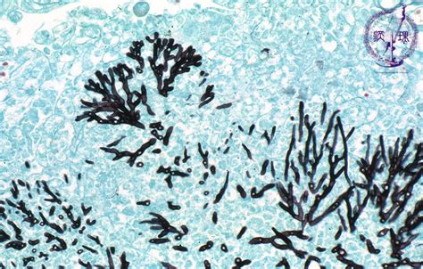 Lung Pleura Fungal Pneumonia Aspergillosis Pathology Core Pictures