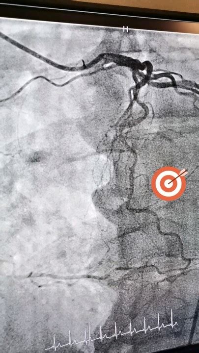 Nenad Ž Božinović Md Ass Profesor Of Internal Medicine On Linkedin Cto Rca With Jcto 4