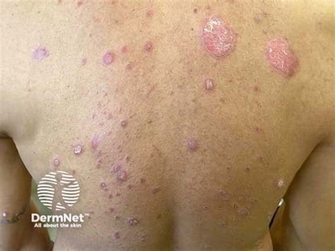Dermnet Psoriasis Psoriasis Symptoms Treatment Images And More