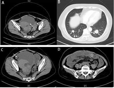 Frontiers Case Report Rupture Of An Ileus Tube In A Patient With