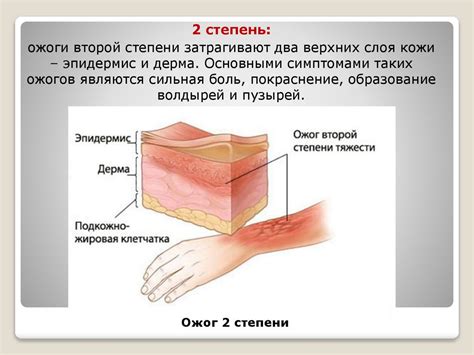 Первая медицинская помощь при ожогах презентация онлайн