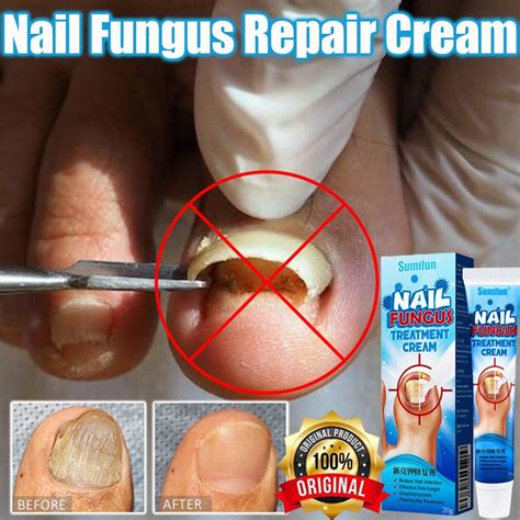 Ubat Kuku Rosak Fungus Nail Repair Cream Nail Fungus Treatment Ubat