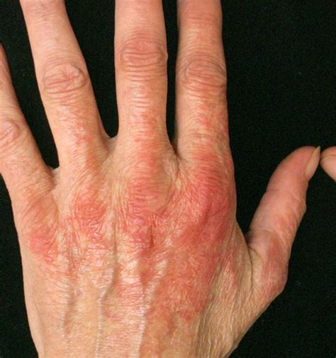 Photodermatitis Pictures Treatment Symptoms And Causes 2018