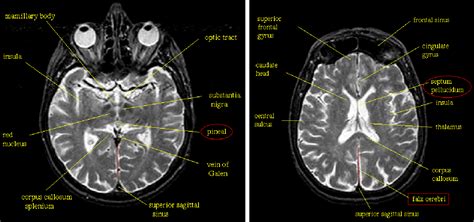Figure 31 From Automated Measurement Of Midline Shift In Brain Ct
