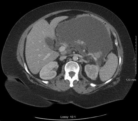 Symptomatic Pseudocyst Download Scientific Diagram