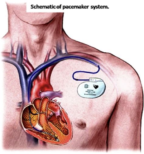Diagram Illustrating The Autonomous Pacemaker System 62 Download