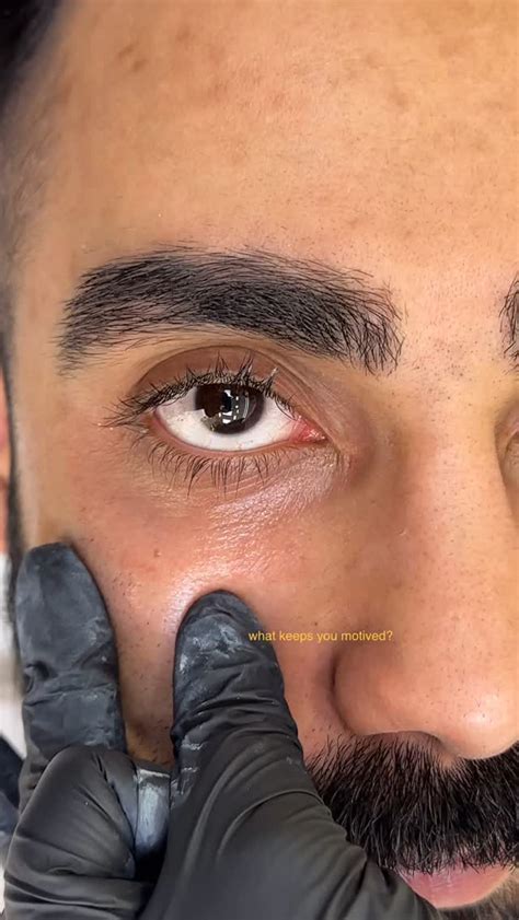 ‎کیلینیک تخصصی پوست و مو پگاه عسکرنیا‎ ‎رفع تیرگی زیر چشم به صورت